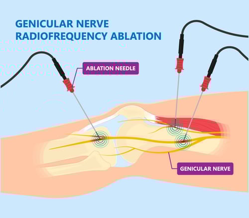 Genicular Nerve Block and Radiofrequency Ablation (RFA) | Excel Pain and Spine