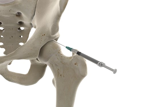 Intra-Articular Hip Injection | Excel Pain and Spine