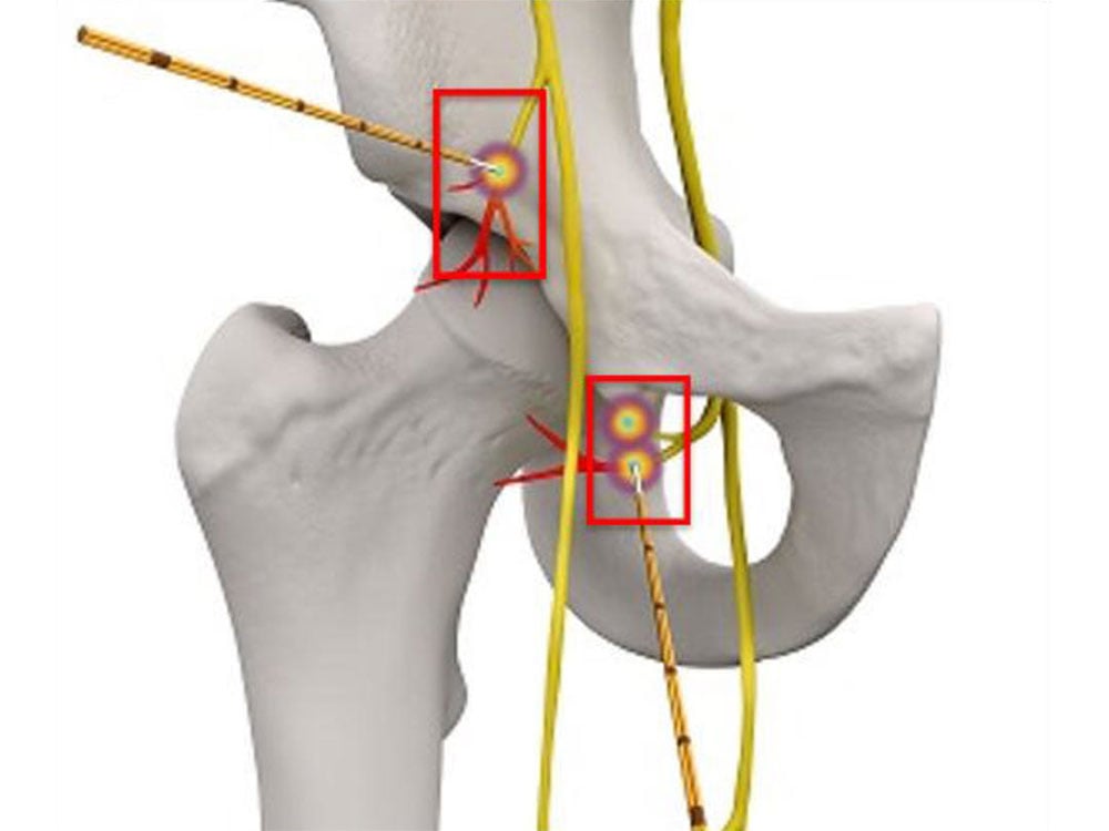 Obturator and Femoral Nerve Blocks and Radiofrequency Ablation | Excel ...