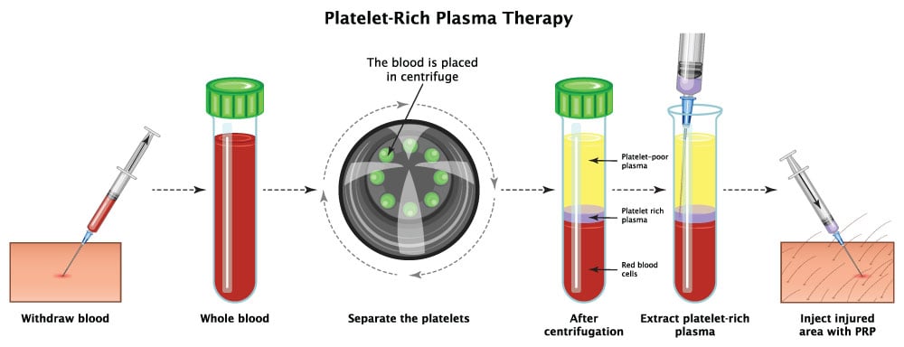 Platelet Rich Plasma (PRP) | Excel Pain and Spine
