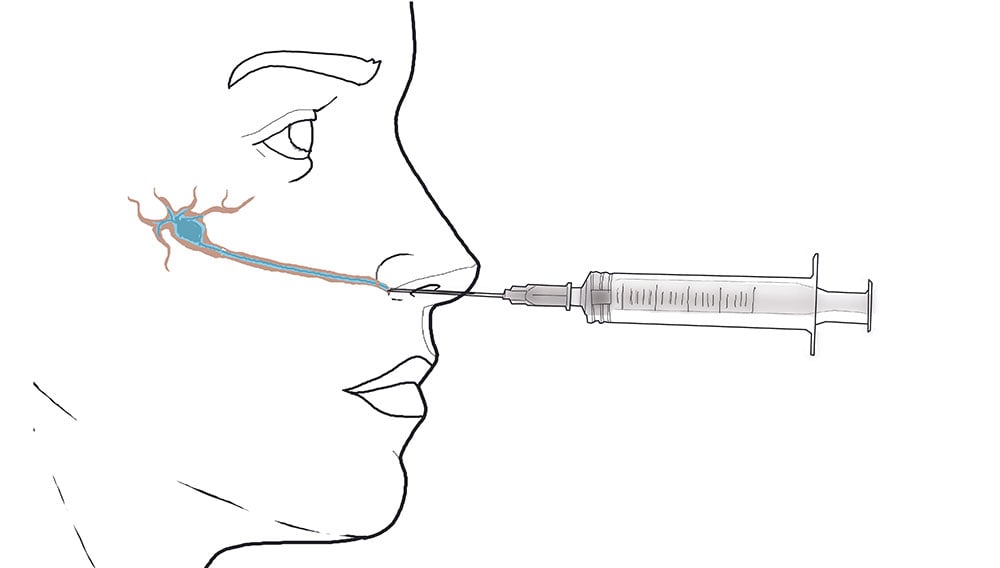 Sphenopalatine Ganglion Nerve Block | Excel Pain and Spine