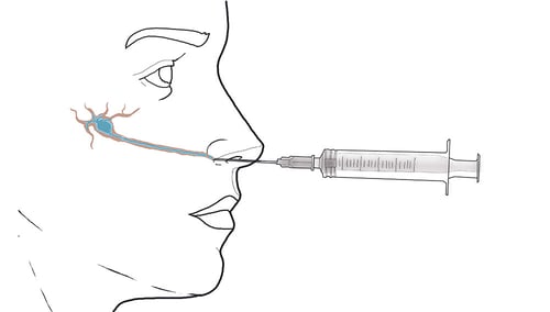Sphenopalatine Ganglion Nerve Block | Excel Pain and Spine