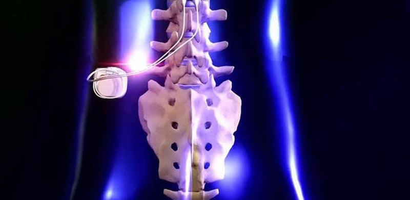 Spinal Cord Stimulator Permanent Implant | Excel Pain and Spine